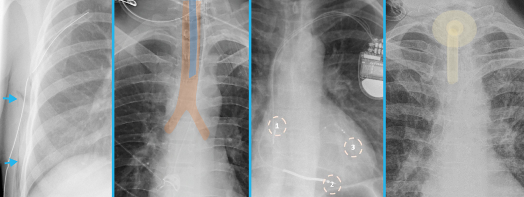 RAIQC: Packages: Package Lines, Tubes and Devices on Chest X-ray